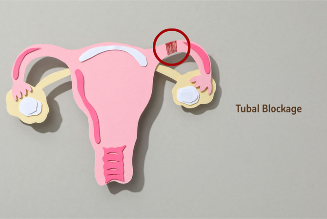 Pathways to Parenthood: Understanding and Overcoming Tubal Blockages ...
